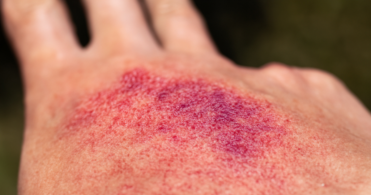 UMass Chan Dermatology Blog: Expert Skin Care & Research