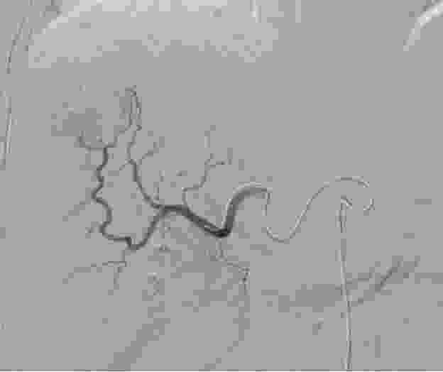 New IR Angiography Suite