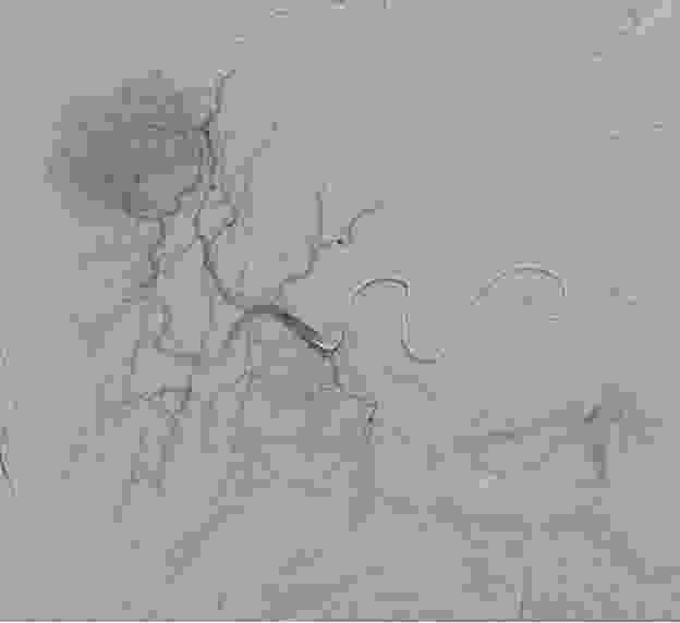 New IR Angiography Suite