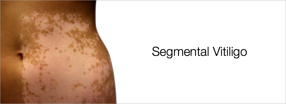 Vitiligo Clinic and Research Center